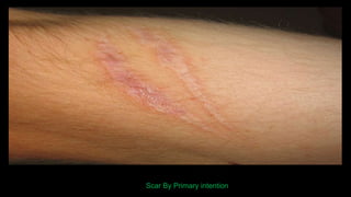 TYPES OF WOUND HEALING by Mishal Khan.pptx
