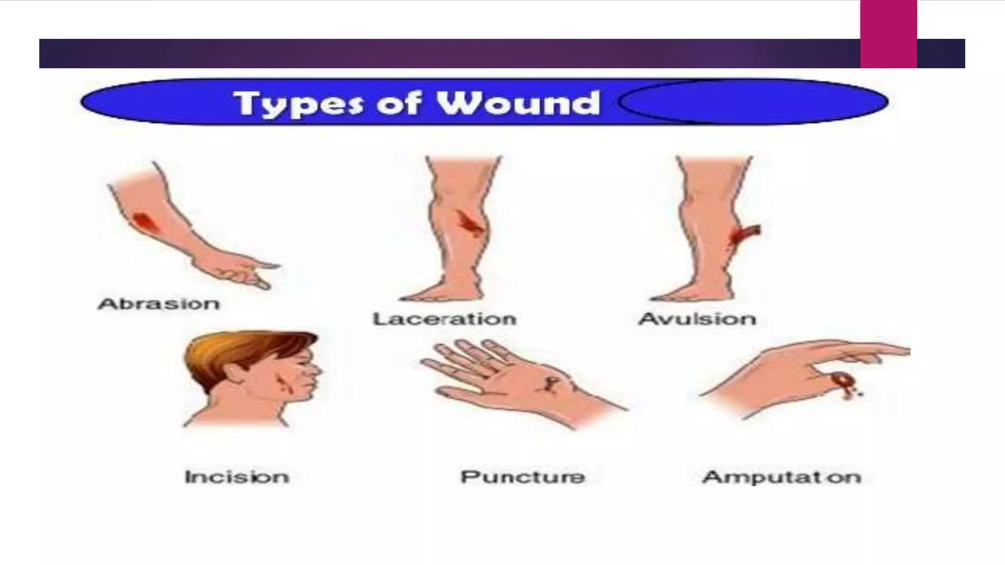 Types of wounds and management. | PPTX