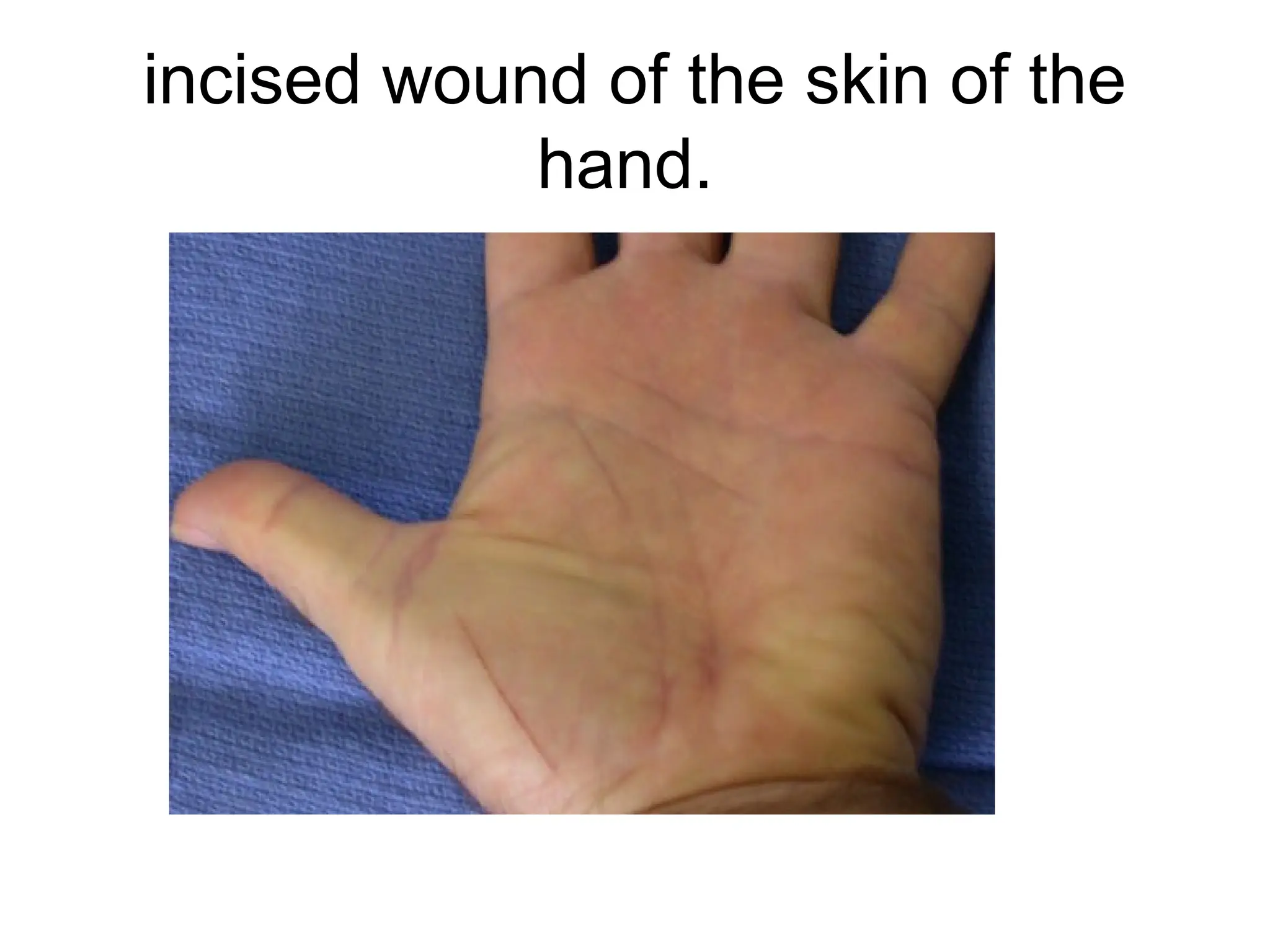 TYPES OF WOUNDS IN FORENSIC MEDICINE I-2.ppt