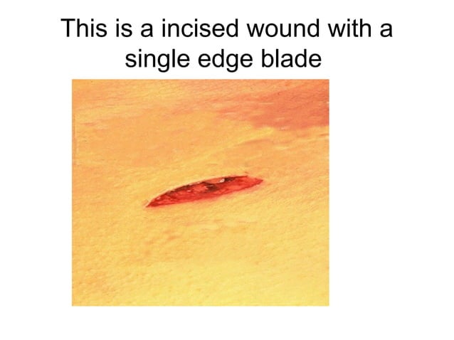 TYPES OF WOUNDS IN FORENSIC MEDICINE I-2.ppt