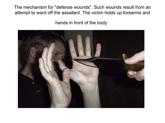 TYPES OF WOUNDS IN FORENSIC MEDICINE I-2.ppt