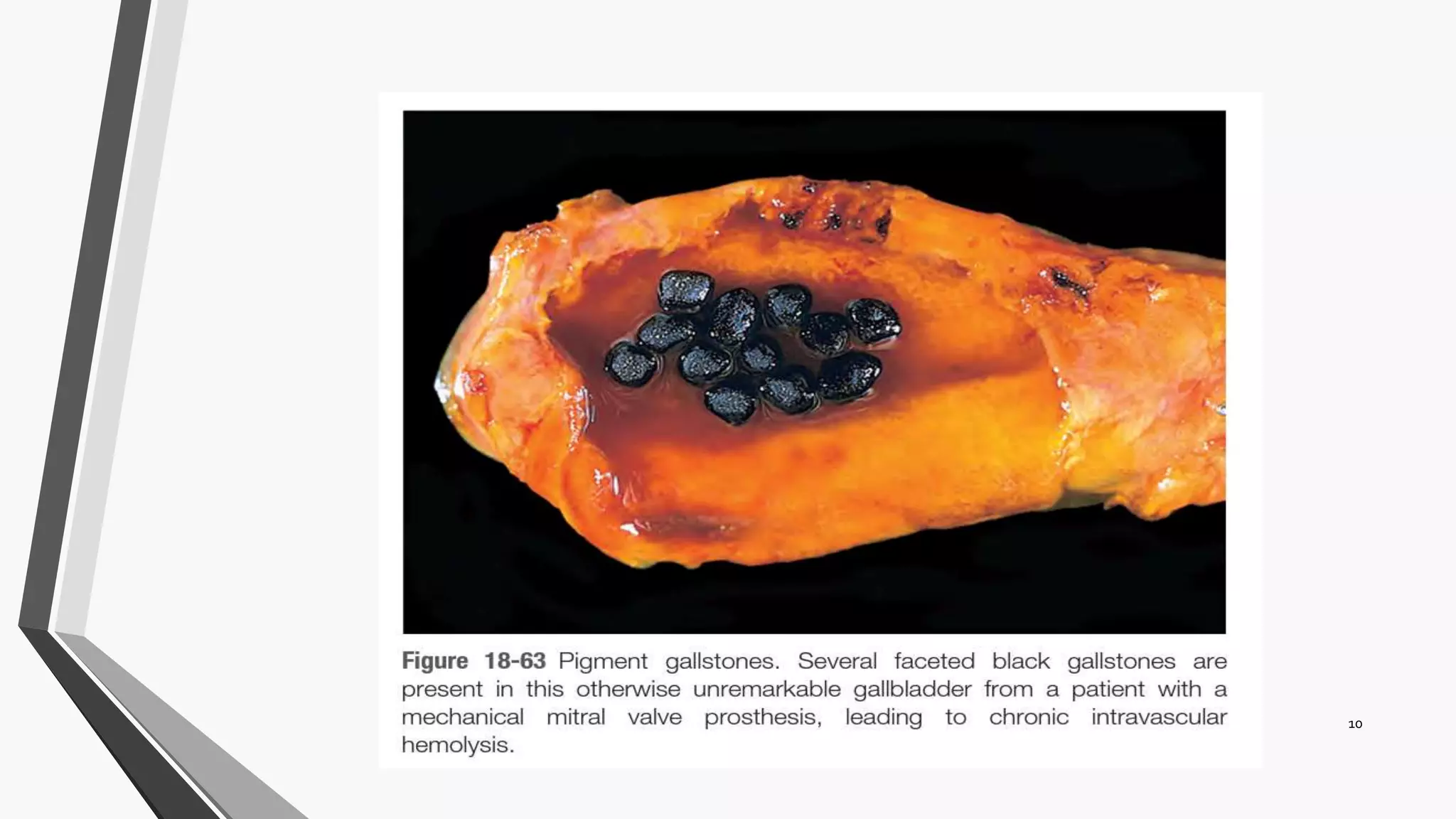 Types,Pathogenesis and Complications of Gallstones-1.pptx
