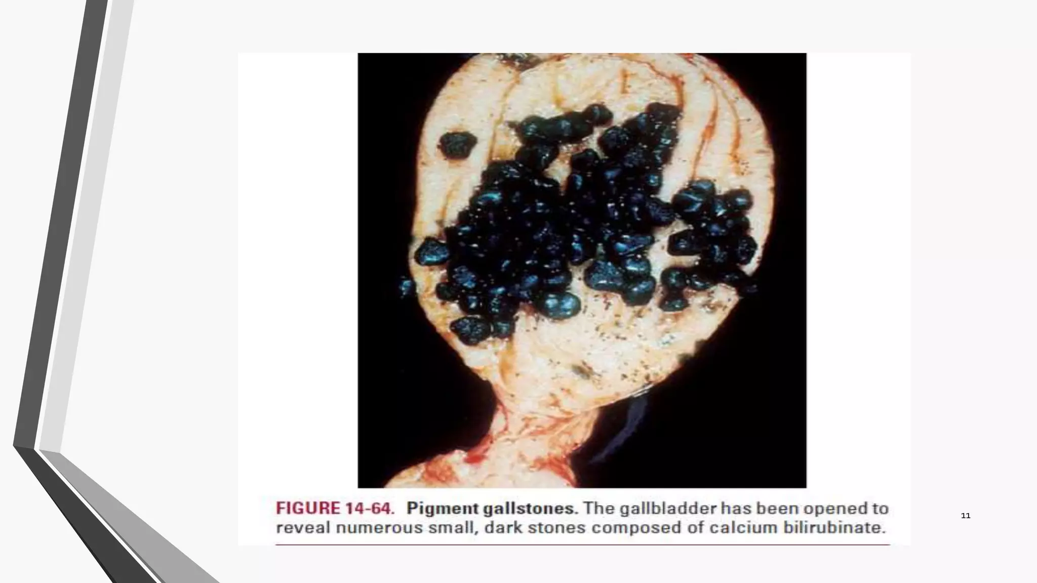 Types,Pathogenesis and Complications of Gallstones-1.pptx