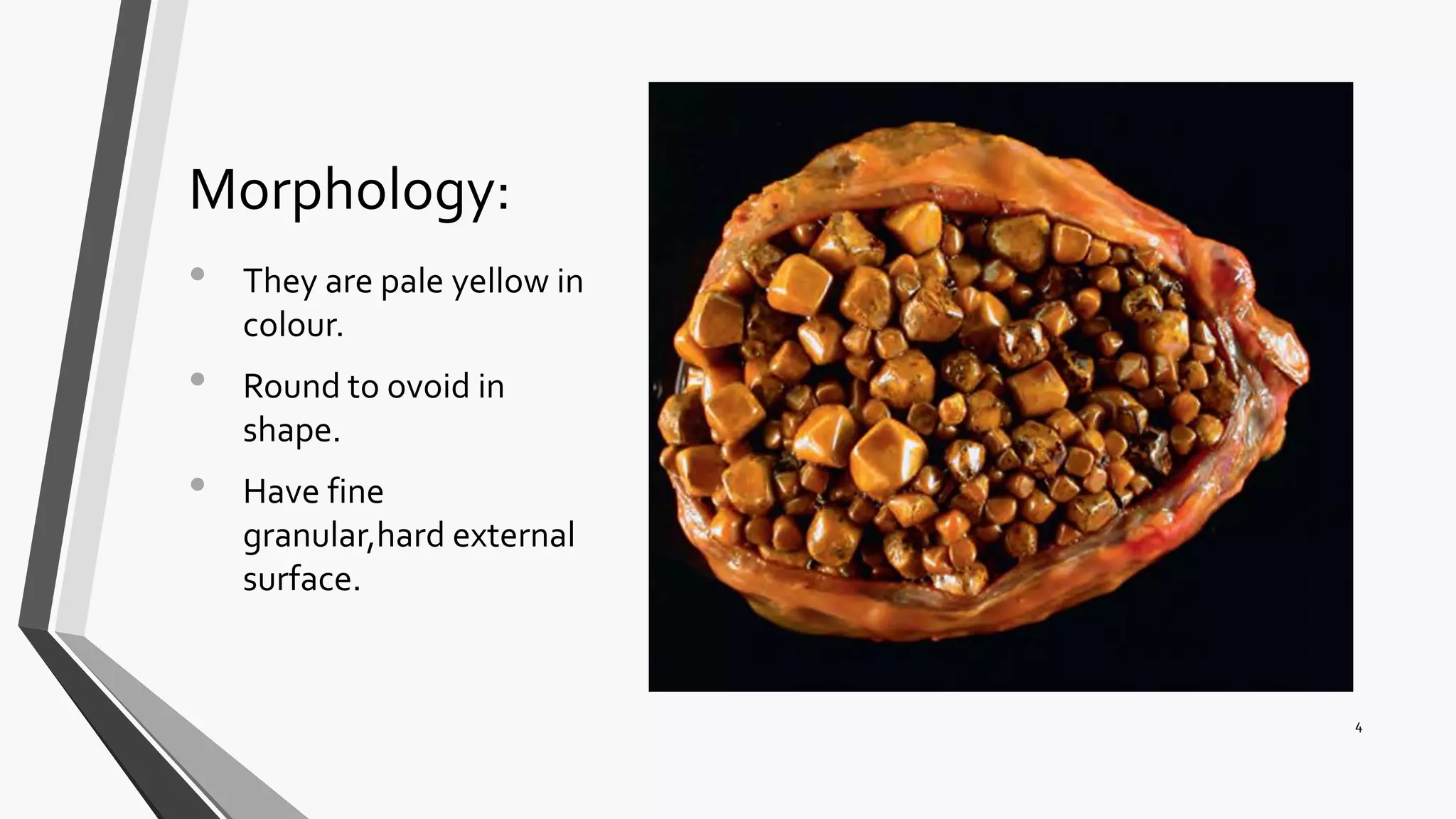 Types,Pathogenesis and Complications of Gallstones-1.pptx
