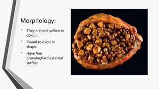 Types,Pathogenesis and Complications of Gallstones-1.pptx