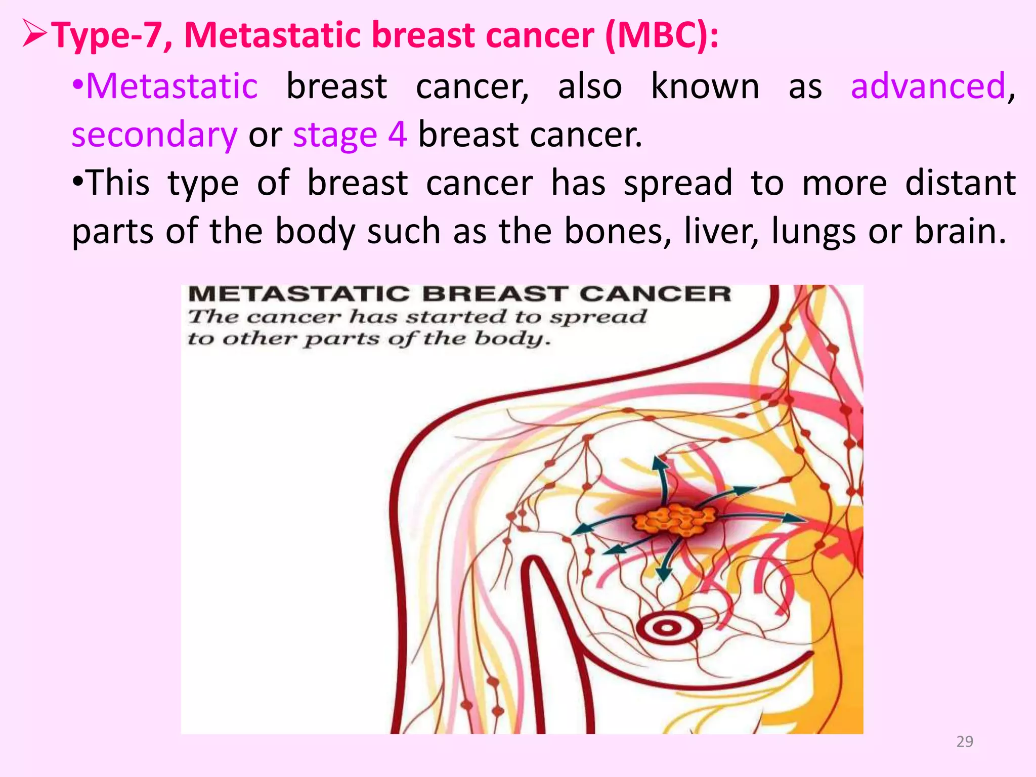 Types & Sub-types of Breast Cancer | PPTX