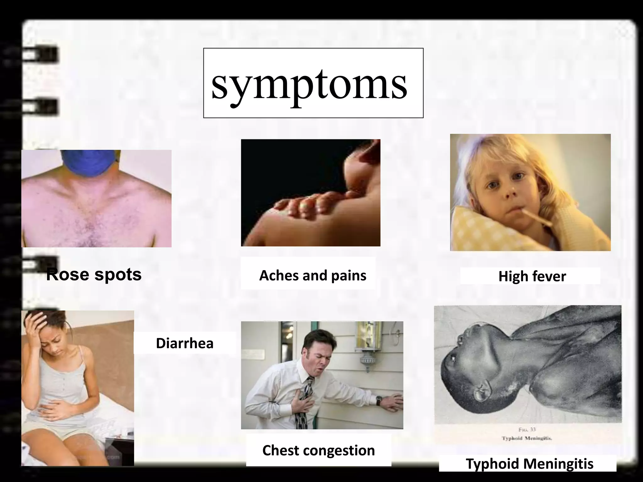 Typhoid | PPTX