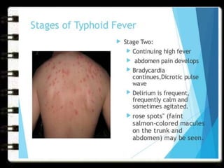Salmonella Typhi Rose Spots