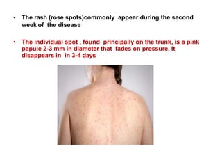 Typhoid | PPTX