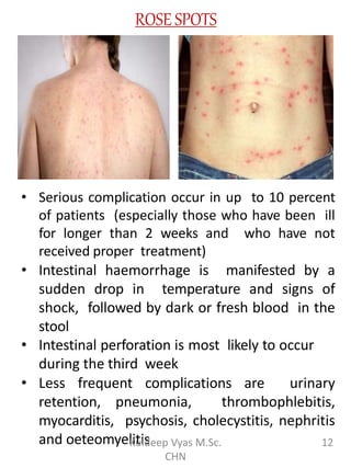 Typhoid (Enteric fever) | PDF