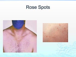 Typhoid & c holera zaim | PPT