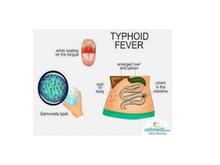 Typhoid control | PPTX