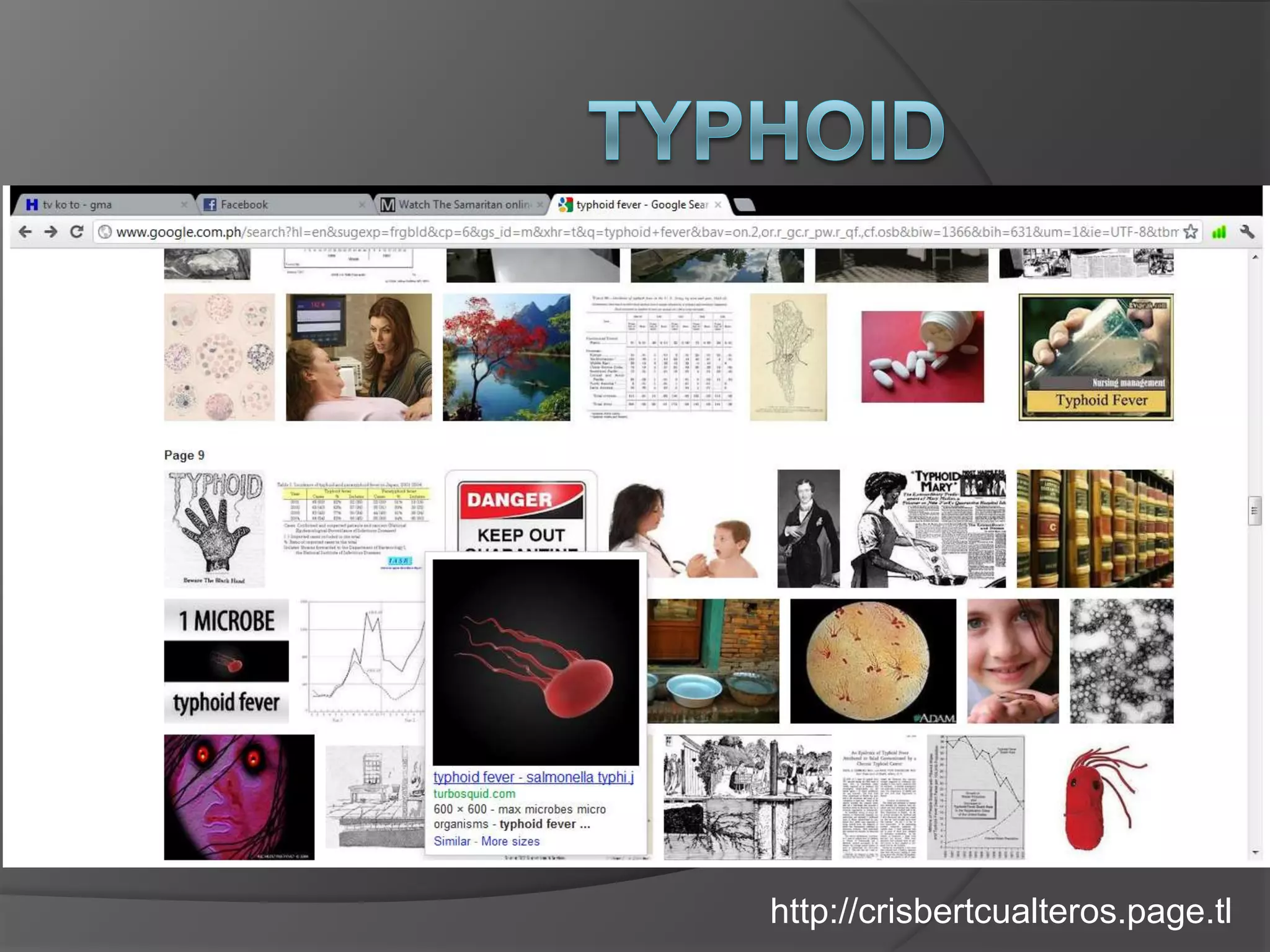 Typhoid Fever: Clinical Manifestations, Diagnosis, Treatment ...