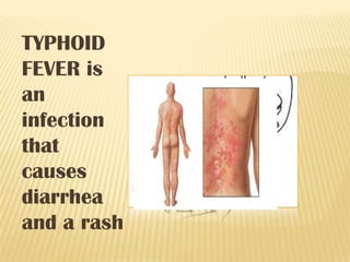 Typhoid fever | PPTX | Infectious Diseases | Diseases and Conditions