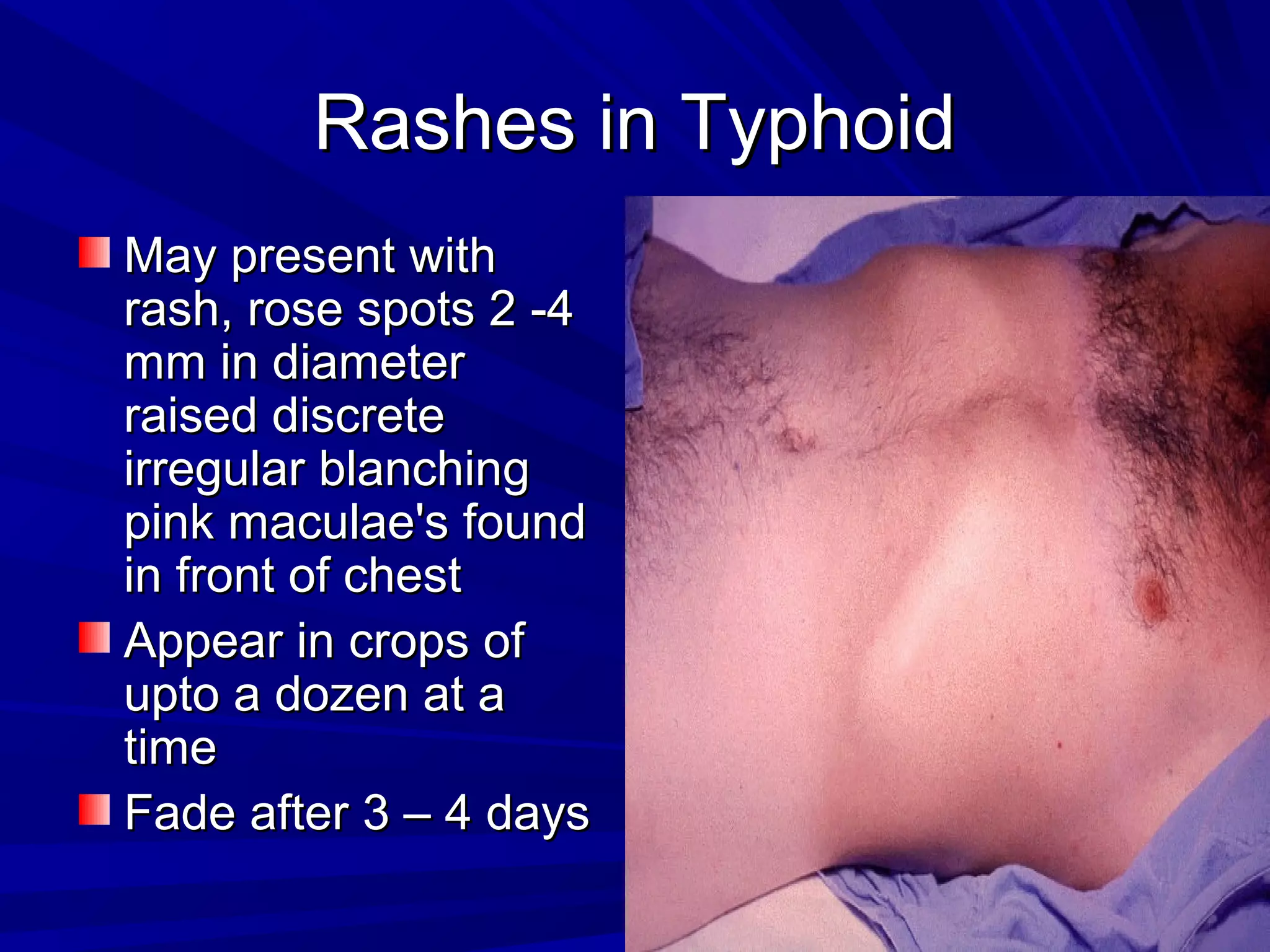 Typhoid fever microbiology | PPT