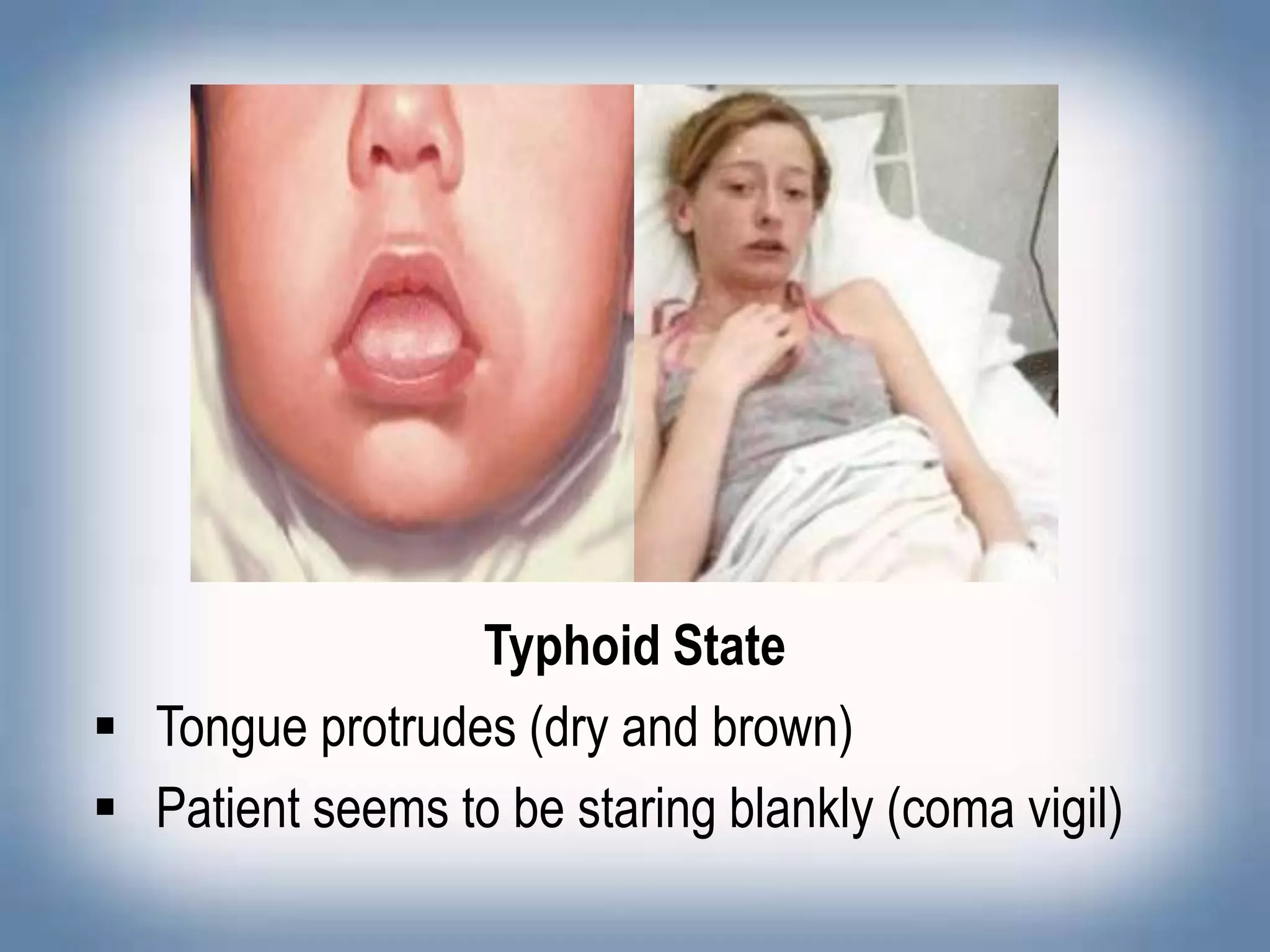 Typhoid fever | PPTX