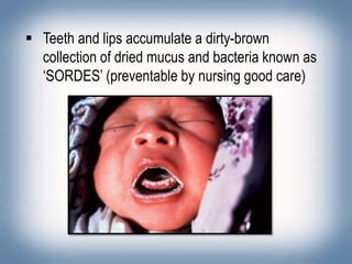 Typhoid fever | PPTX