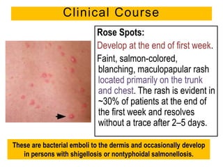 Typhoid Fever Rose Spots