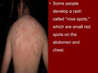 Salmonella Typhi Rose Spots
