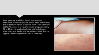 Typhoid fever | PPTX | Digestive Disorders | Diseases and Conditions