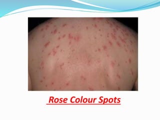 TYPHOID FEVER | PPTX