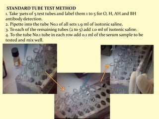 Typhoid fever madhuri | PPT