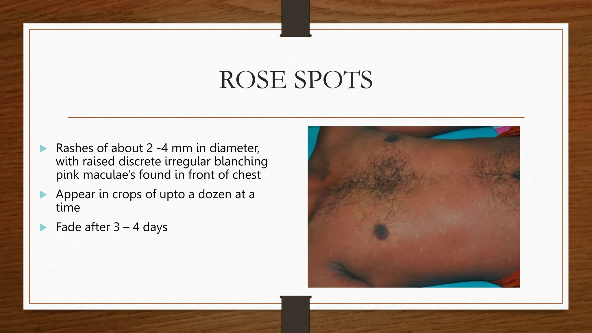 TYHOID ILEAL PERFORATION, COMPLICATIONS AND MANAGEMENT | PPTX