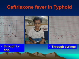 TYPHOID_FEVER_IN_CHILDREN (1).ppt