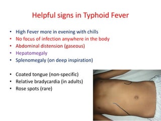 Typhoid fever in children 2021 | PDF