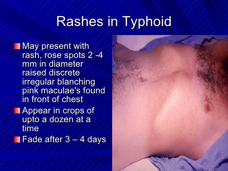 Typhoid Fever Lecture