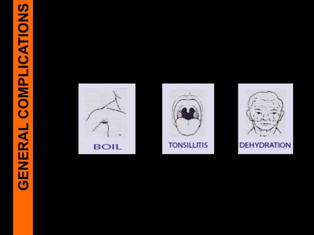 Typhoid fever ppt | PPTX | Digestive Disorders | Diseases and Conditions