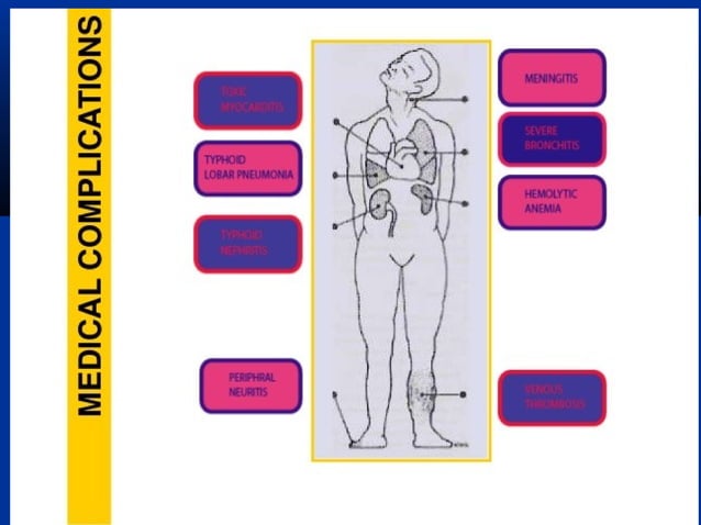 Typhoid fever ppt | PPT