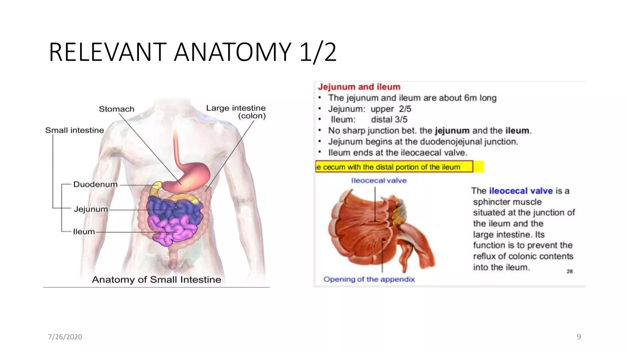 Typhoid intestinal perforation | PPTX
