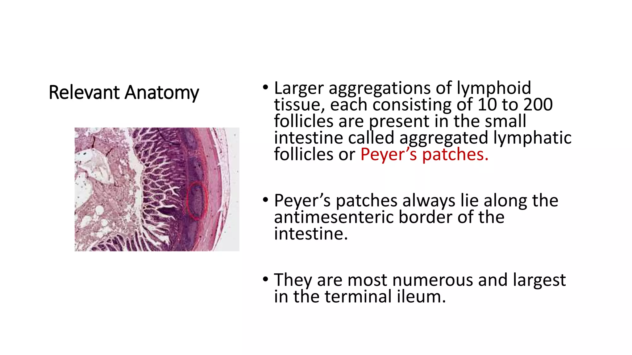 TYPHOID INTESTINAL PERFORATION | PPTX