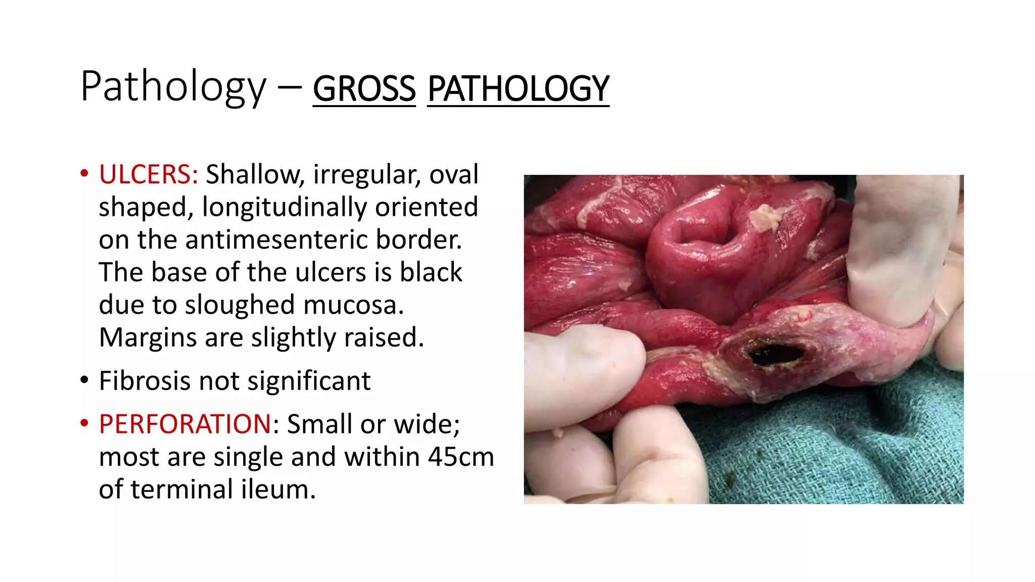 TYPHOID INTESTINAL PERFORATION | PPTX