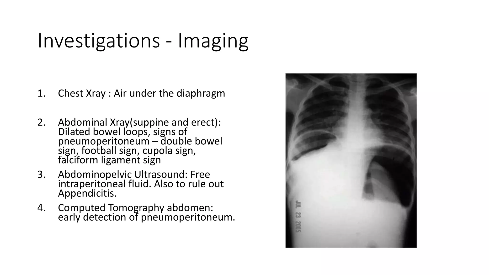 TYPHOID INTESTINAL PERFORATION | PPTX