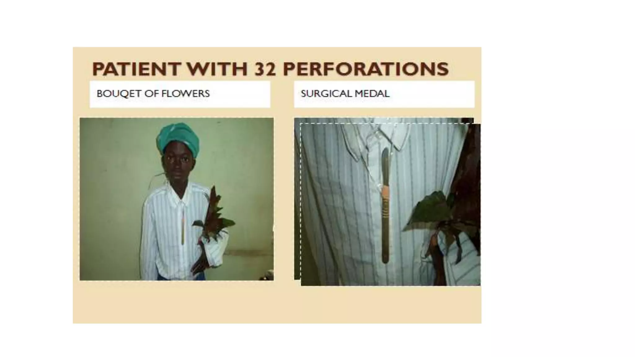 TYPHOID INTESTINAL PERFORATION | PPTX