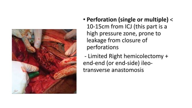 TYPHOID INTESTINAL PERFORATION | PPTX | Infectious Diseases | Diseases ...