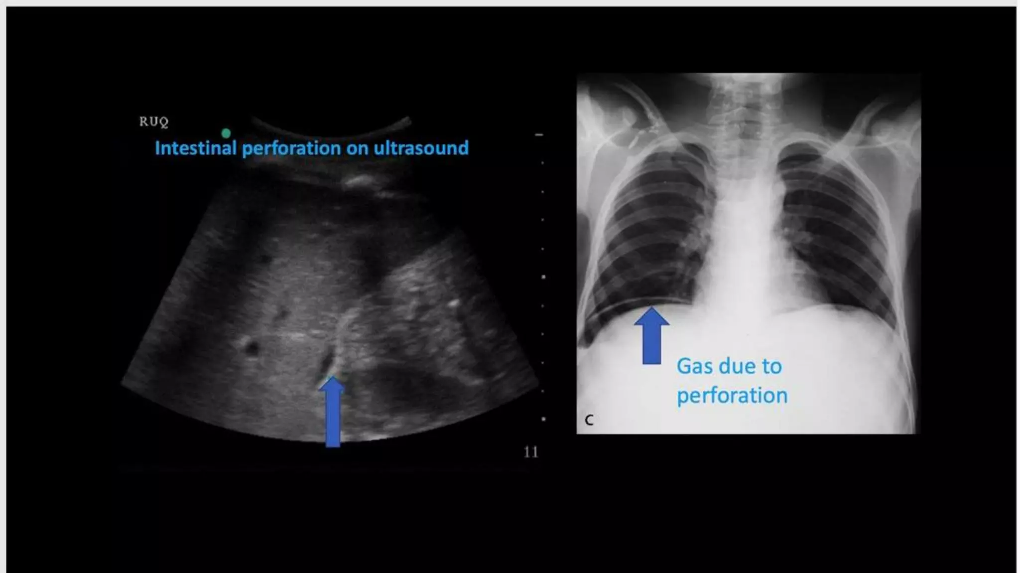 Typhoid Perforation | PPTX