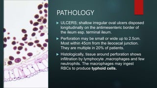 Typhoid Perforation | PPTX