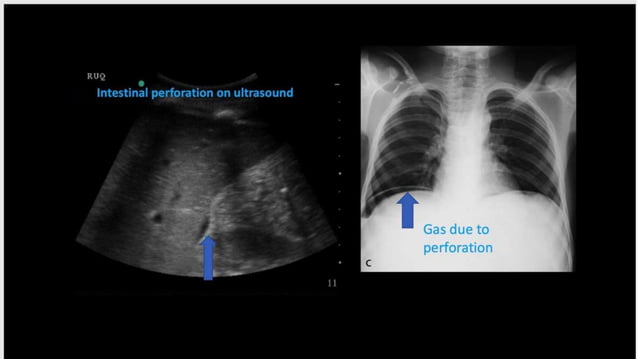 Typhoid Perforation | PPTX