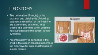 Typhoid Perforation | PPTX