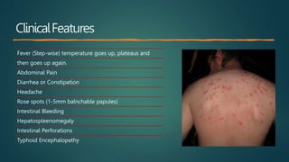 Typhoid Perforation | PPTX