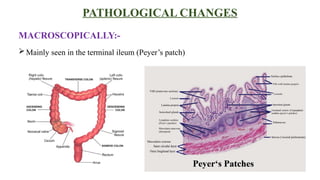 Typhoid ulcers, Enteric fever, all paramedical, B.Sc. Nursing ...