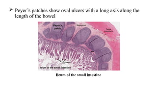 Typhoid ulcers, Enteric fever, all paramedical, B.Sc. Nursing ...