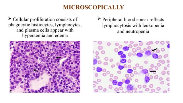 Typhoid ulcers, Enteric fever, all paramedical, B.Sc. Nursing ...