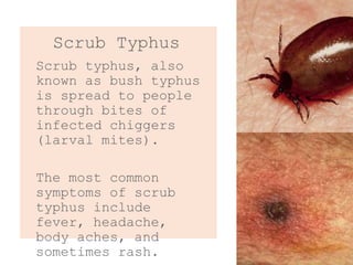 Typhus Fever and its epidemiology worldwide.pptx