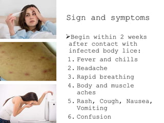 Typhus Fever and its epidemiology worldwide.pptx