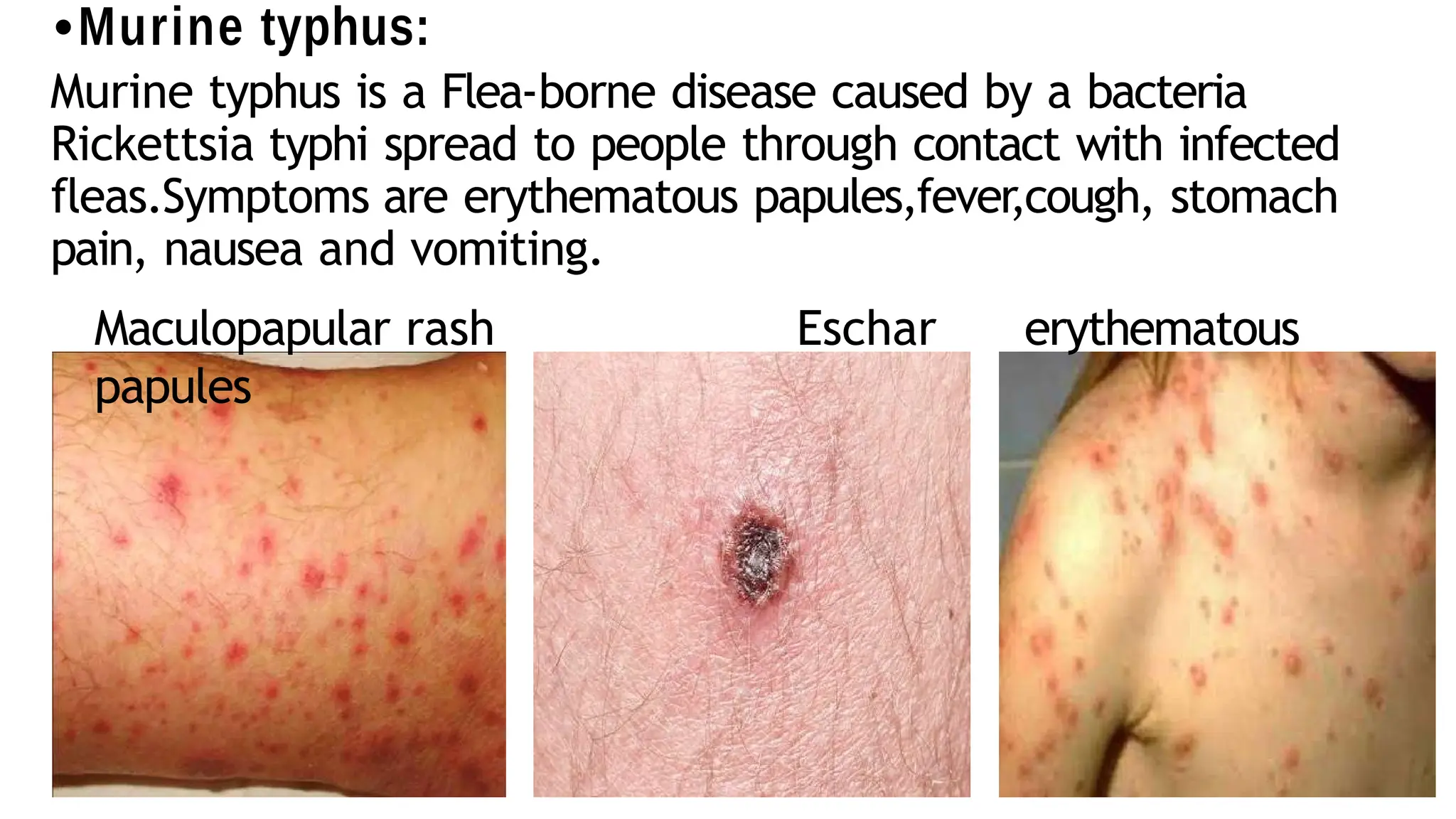 Typhus fever Submitted to Submitted by.pptx | Infectious Diseases ...