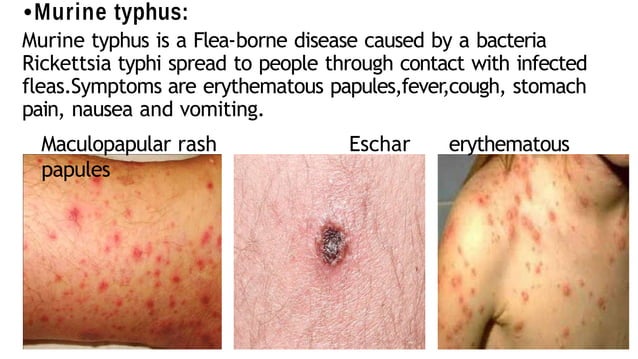 Typhus fever Submitted to Submitted by.pptx